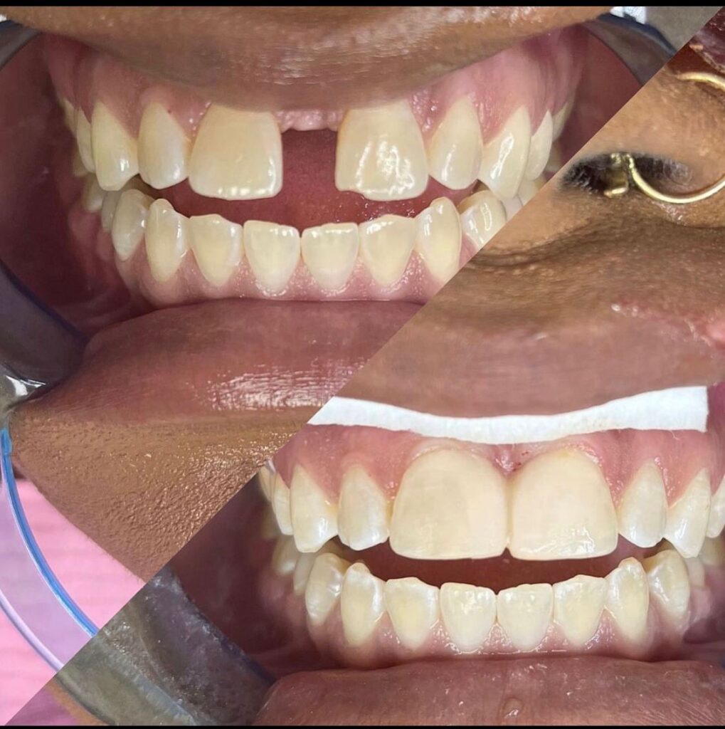 Solo Smile Solutions – We specializes in affordable, noninvasive teeth ...